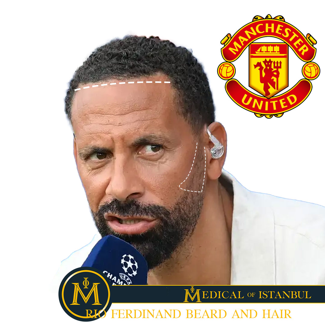 Rio Ferdinand Hair and Beard transplant Amazing Result 2024